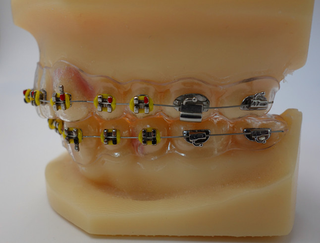 Clear Retainer with Brackets - ZHO